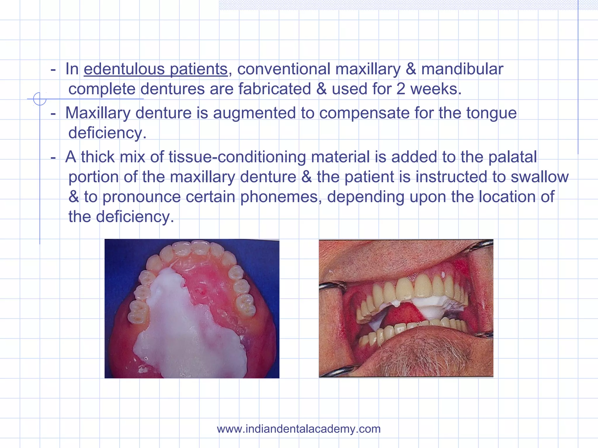 Glossectomy/ dental crown & bridge courses | PPT