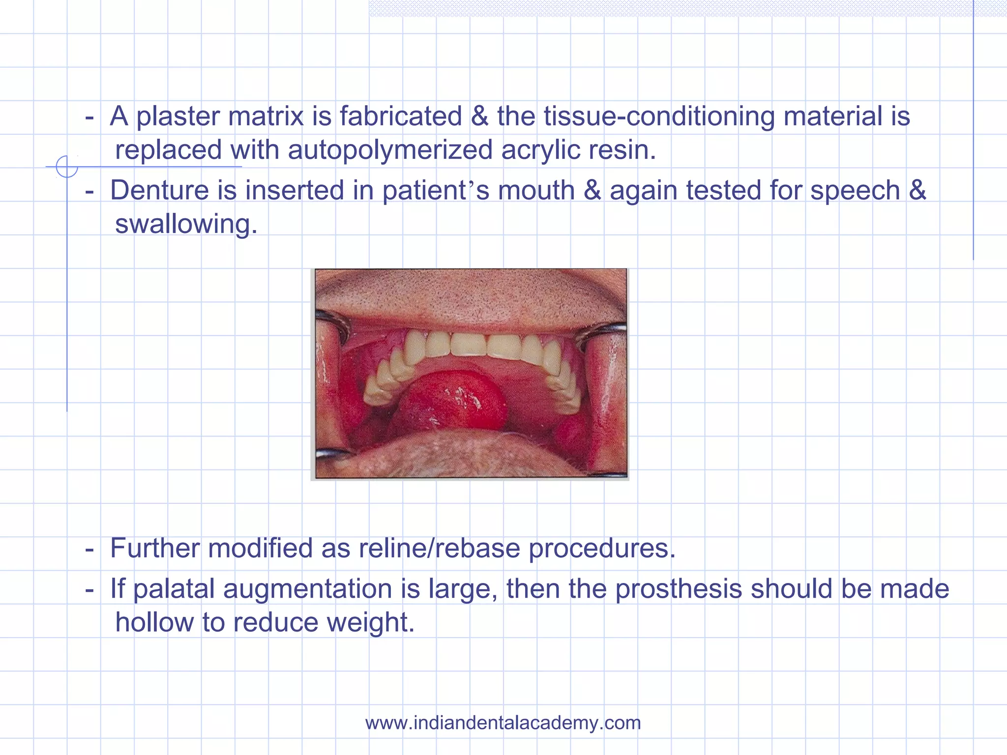 Glossectomy/ dental crown & bridge courses | PPT