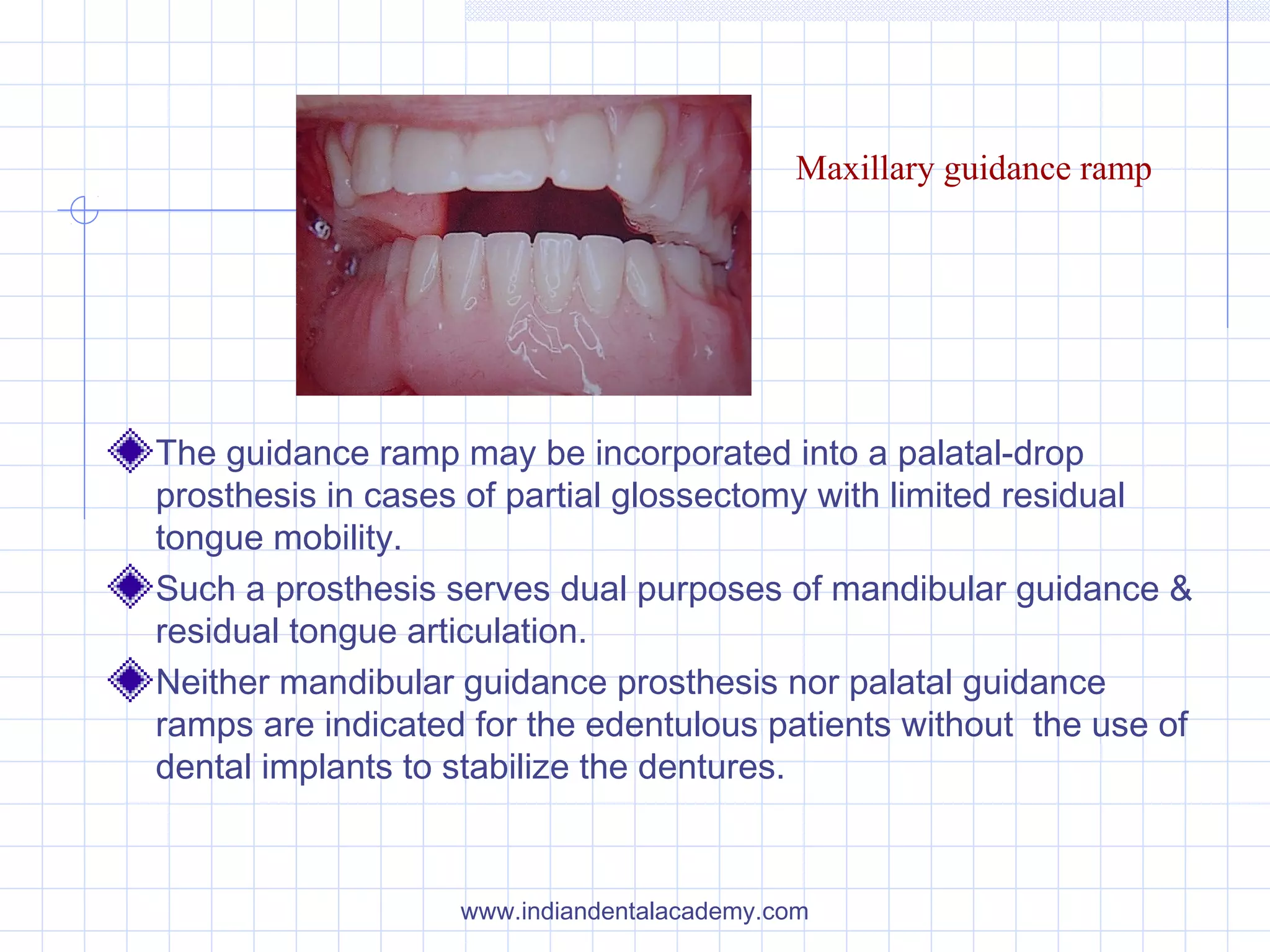 Glossectomy/ dental crown & bridge courses | PPT
