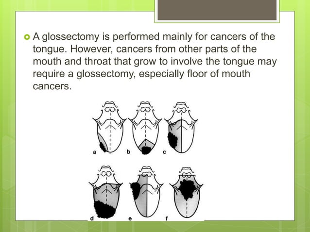 Glossectomy presentation