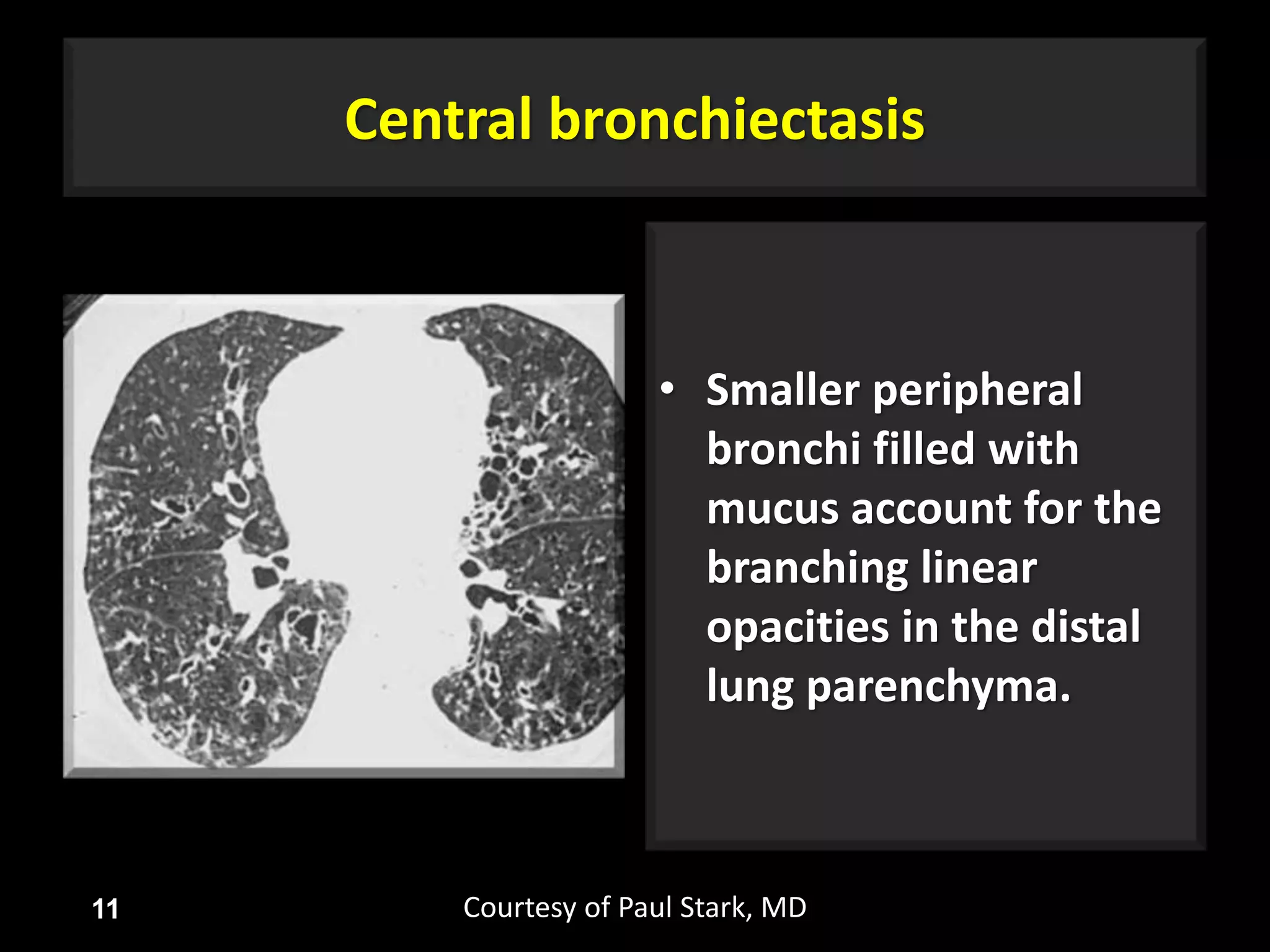 Gloved finger sign and cervicothoracic sign | PPTX