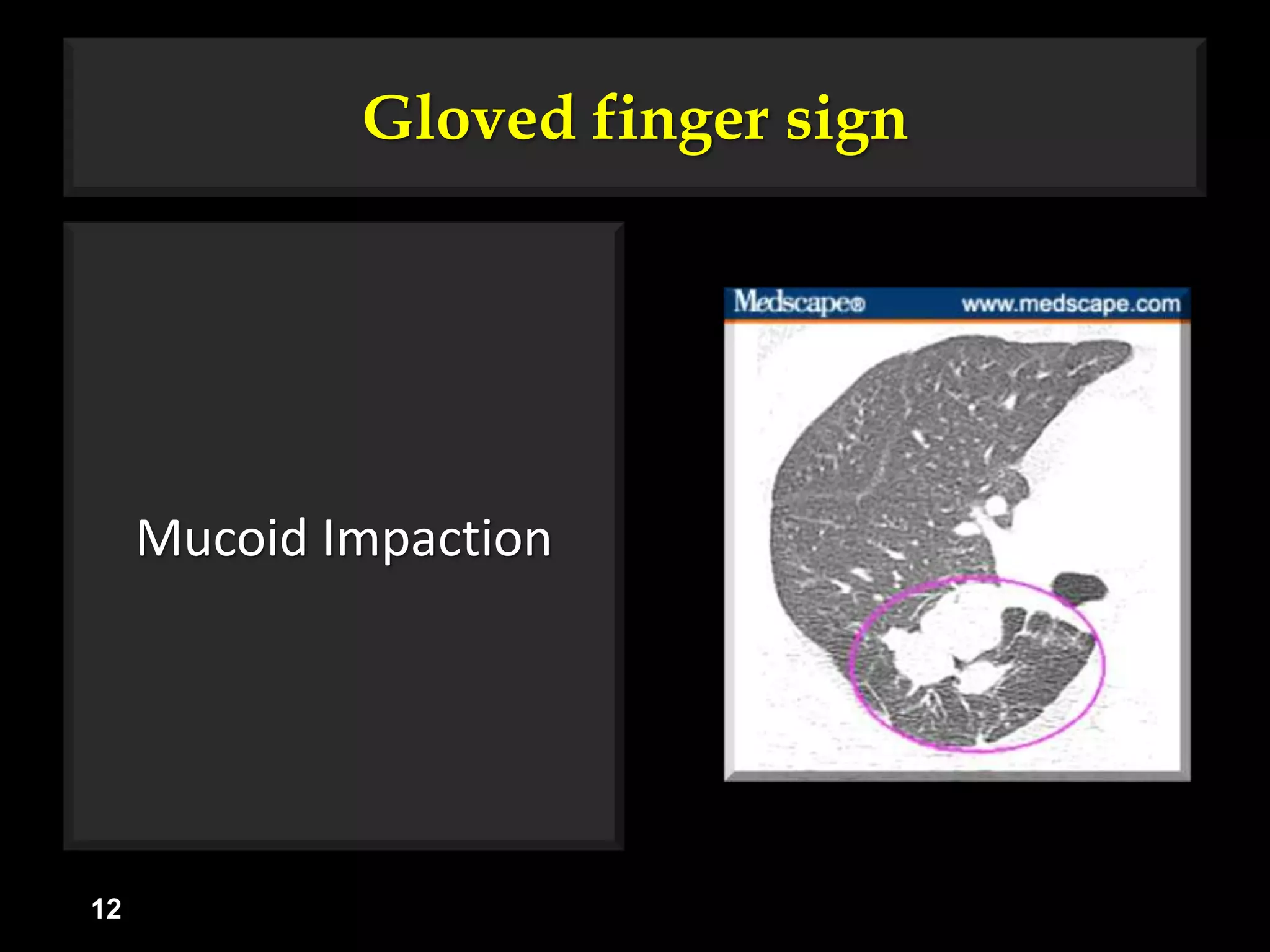 Gloved finger sign and cervicothoracic sign | PPTX