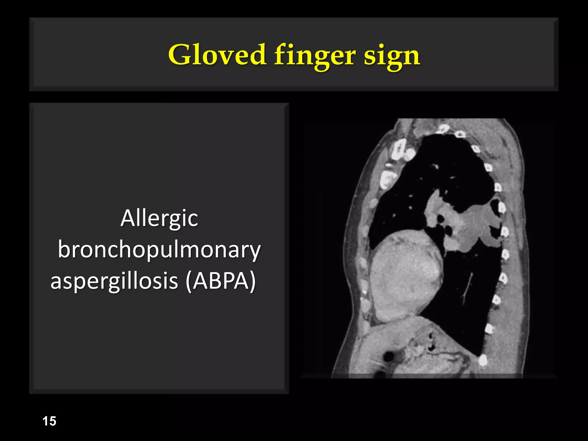 Gloved finger sign and cervicothoracic sign | PPTX