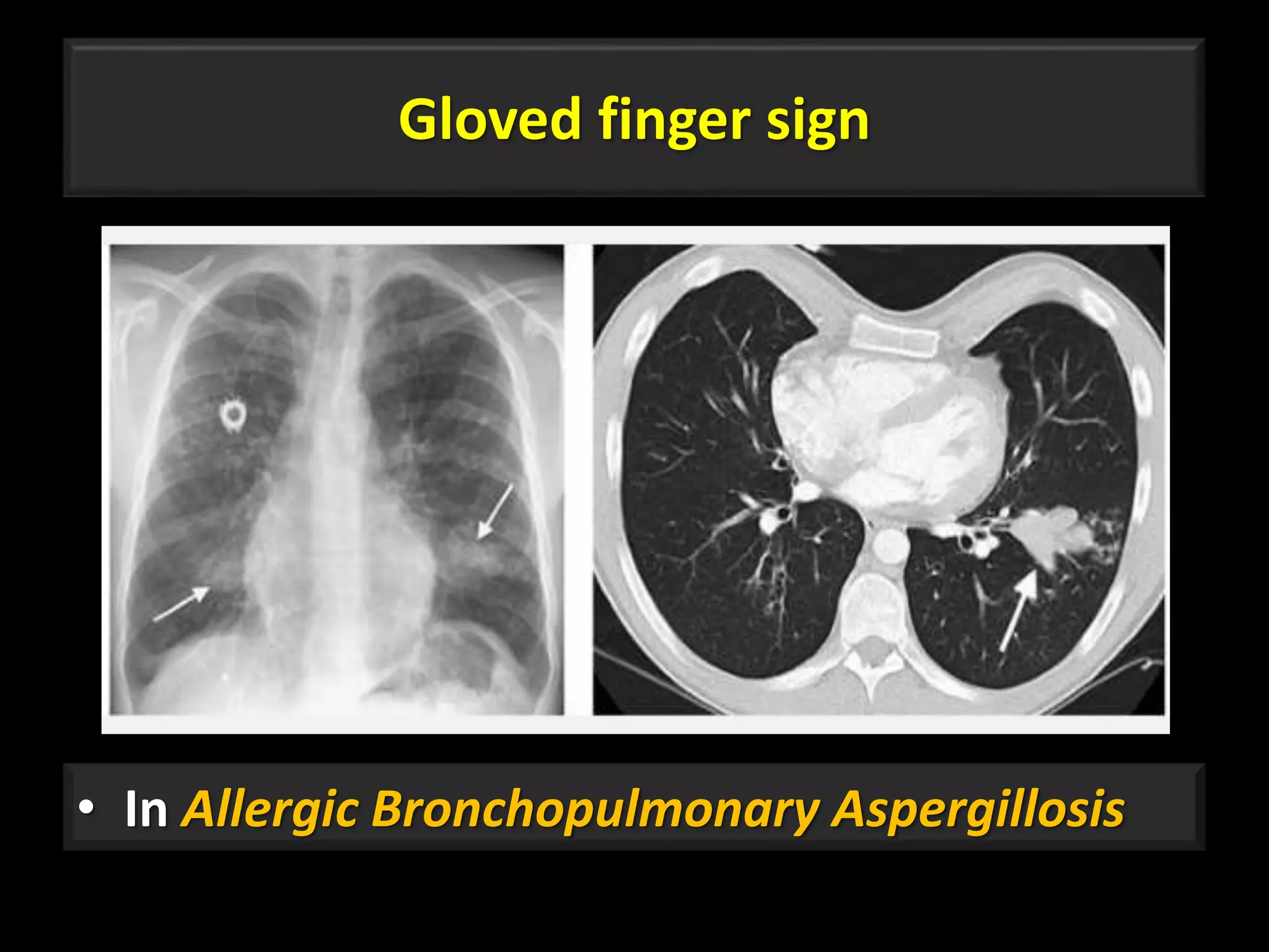 Gloved finger sign and cervicothoracic sign | PPTX