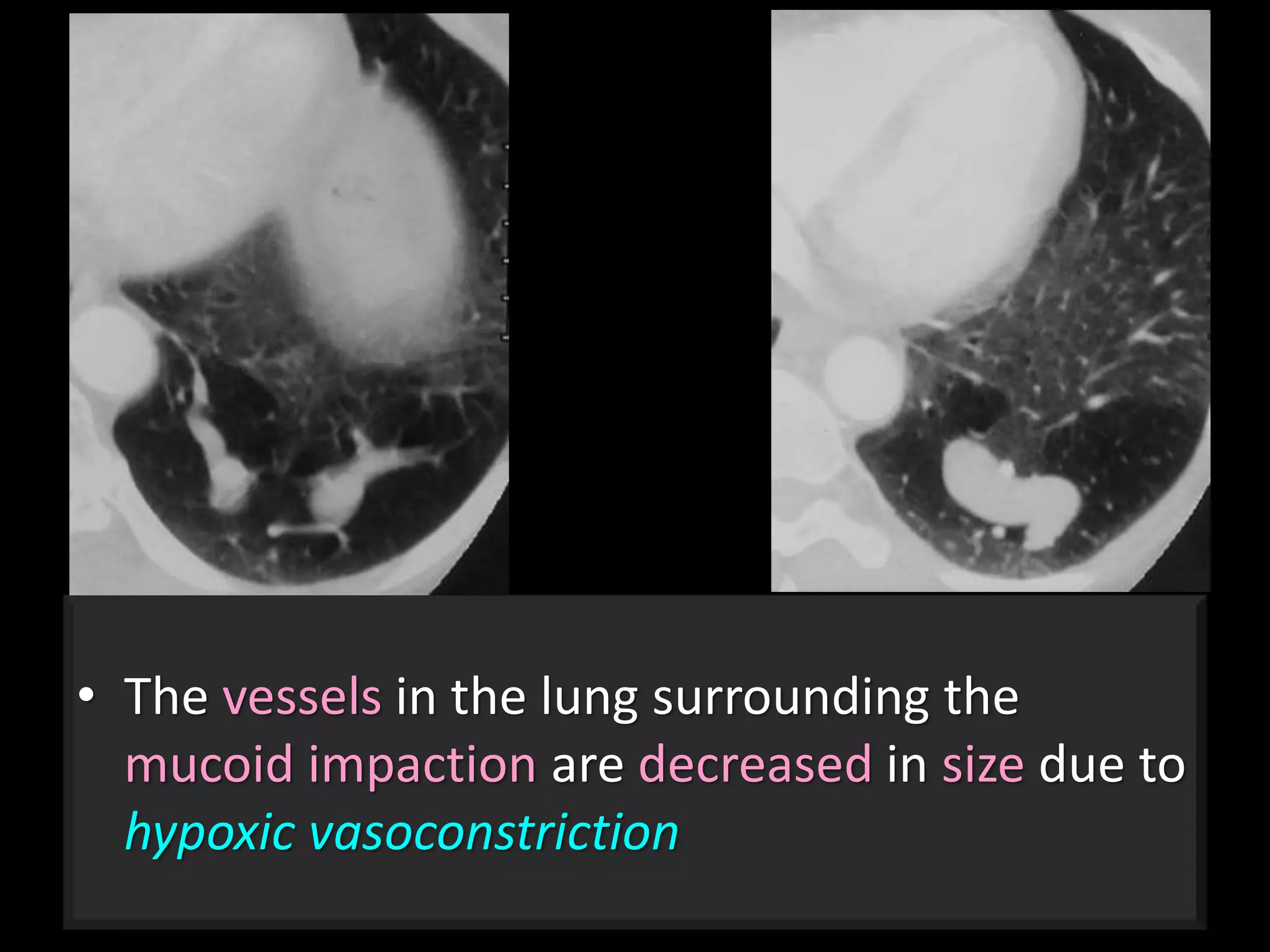 Gloved finger sign and cervicothoracic sign | PPTX