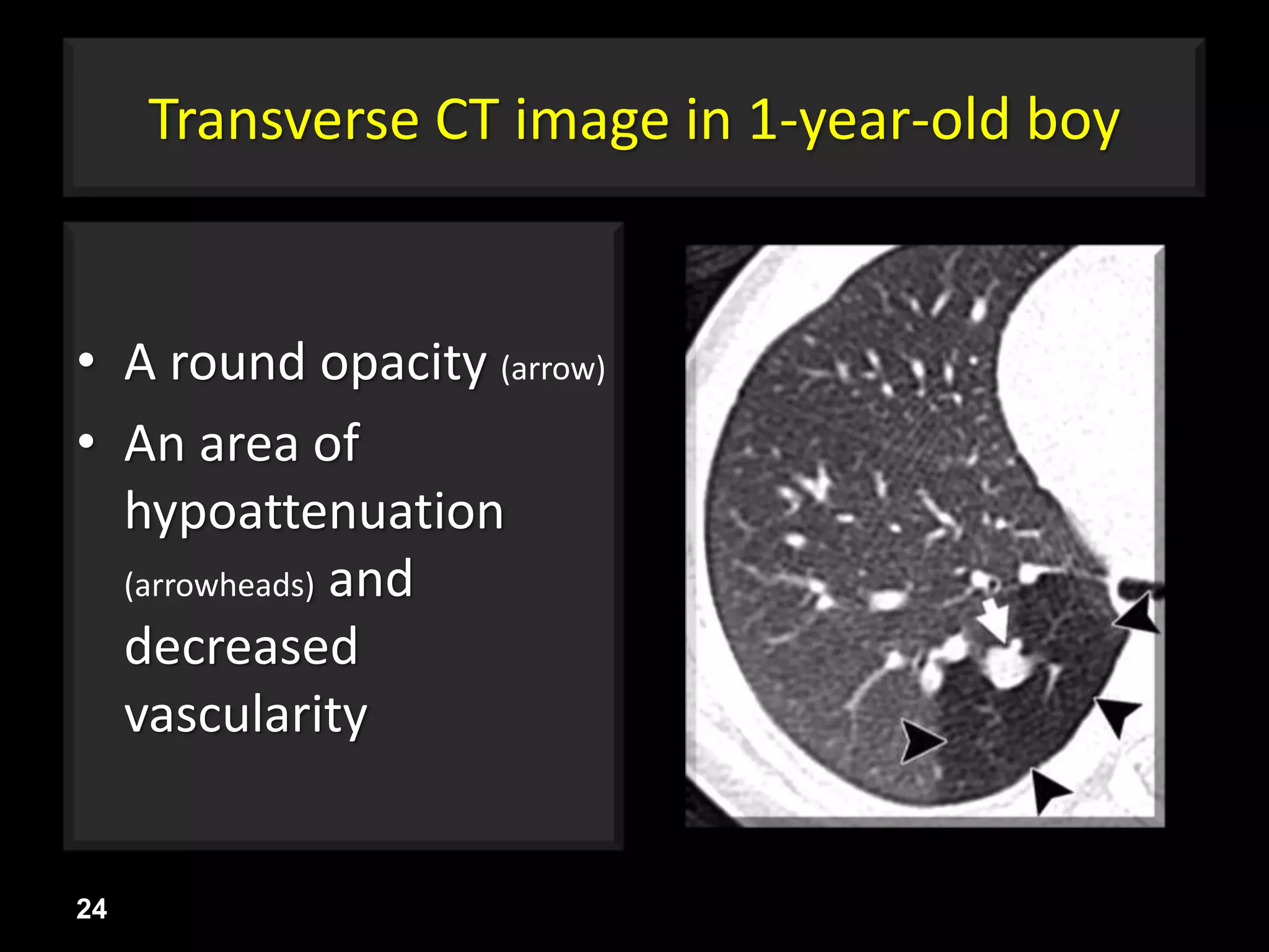 Gloved finger sign and cervicothoracic sign | PPTX