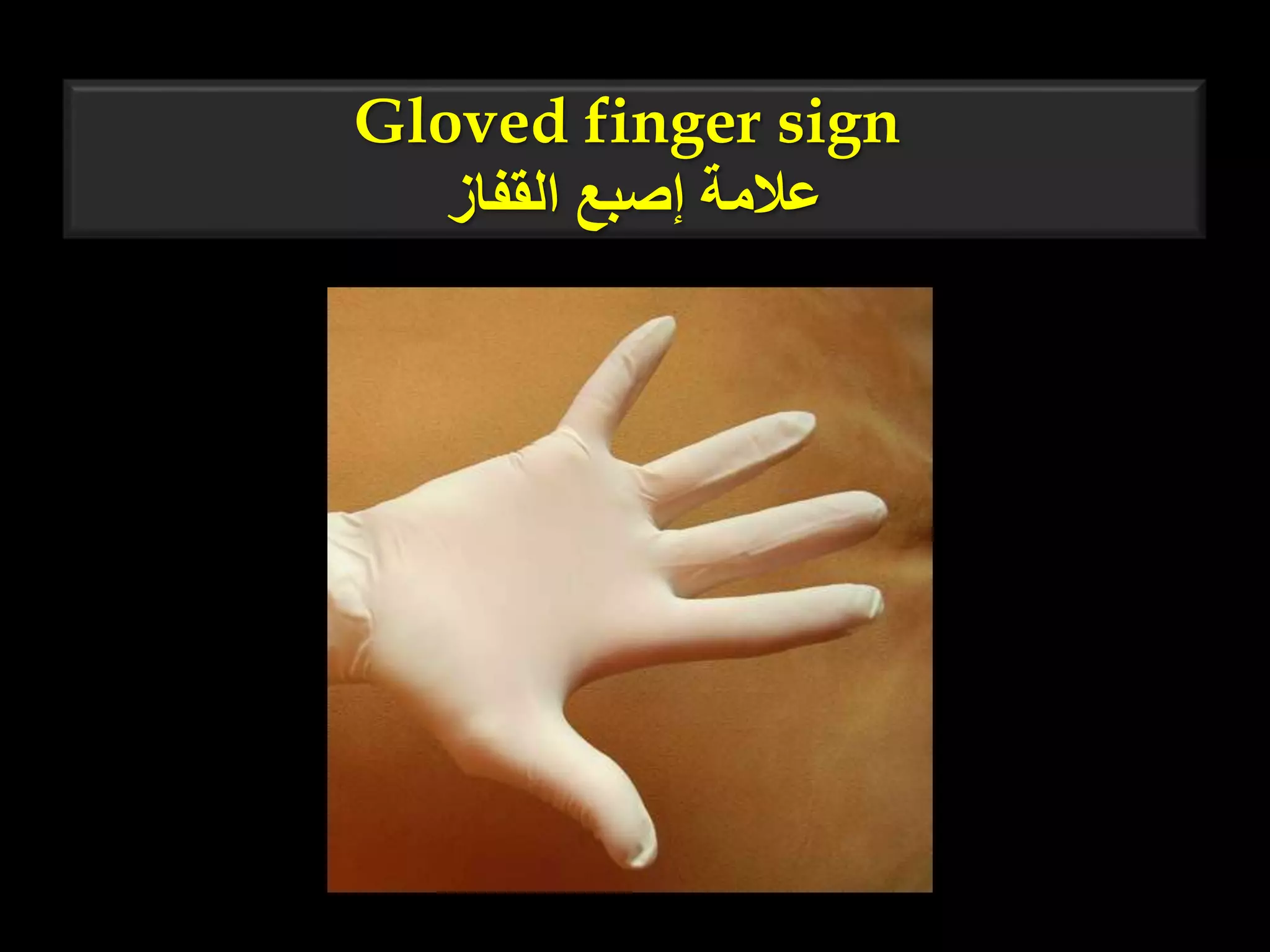 Gloved finger sign and cervicothoracic sign | PPTX