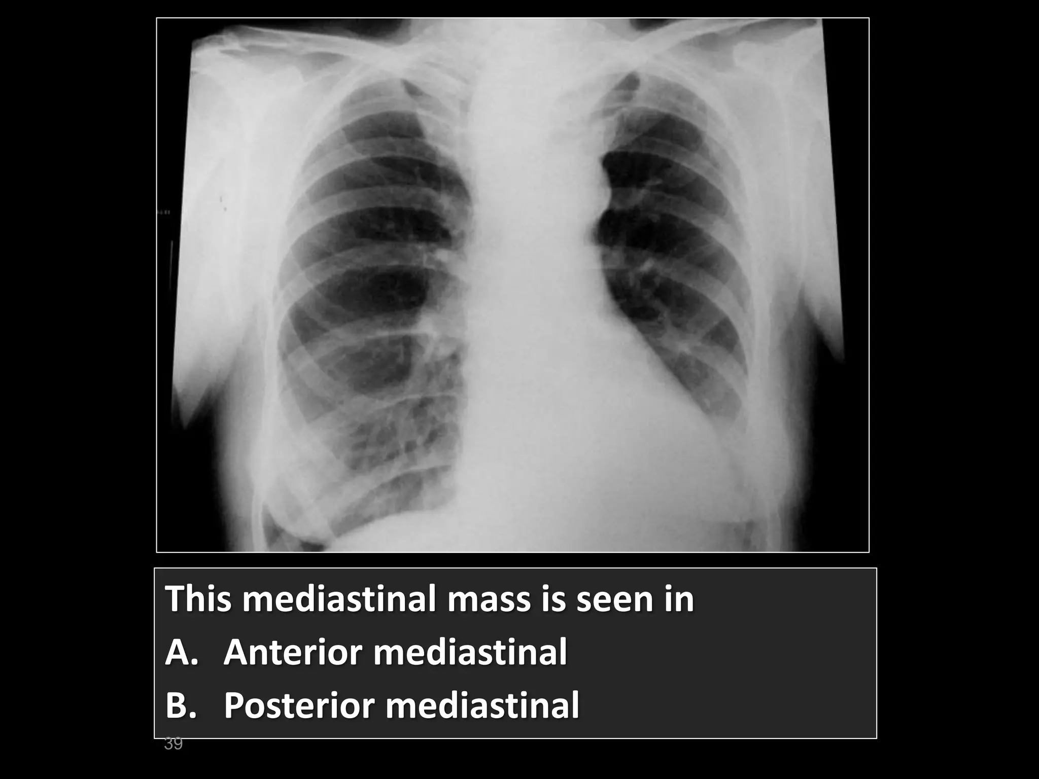Gloved finger sign and cervicothoracic sign | PPTX