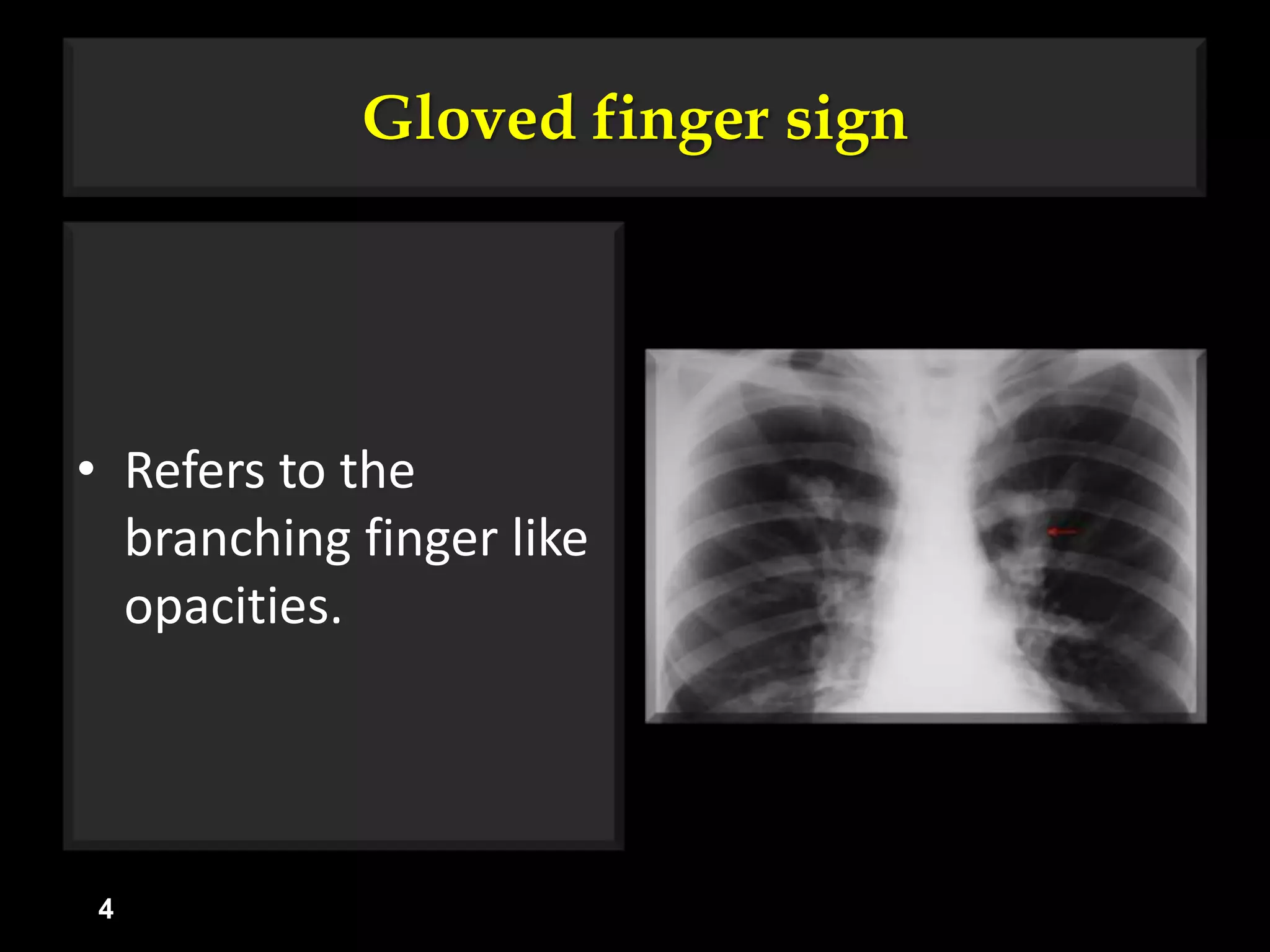 Gloved finger sign and cervicothoracic sign | PPTX