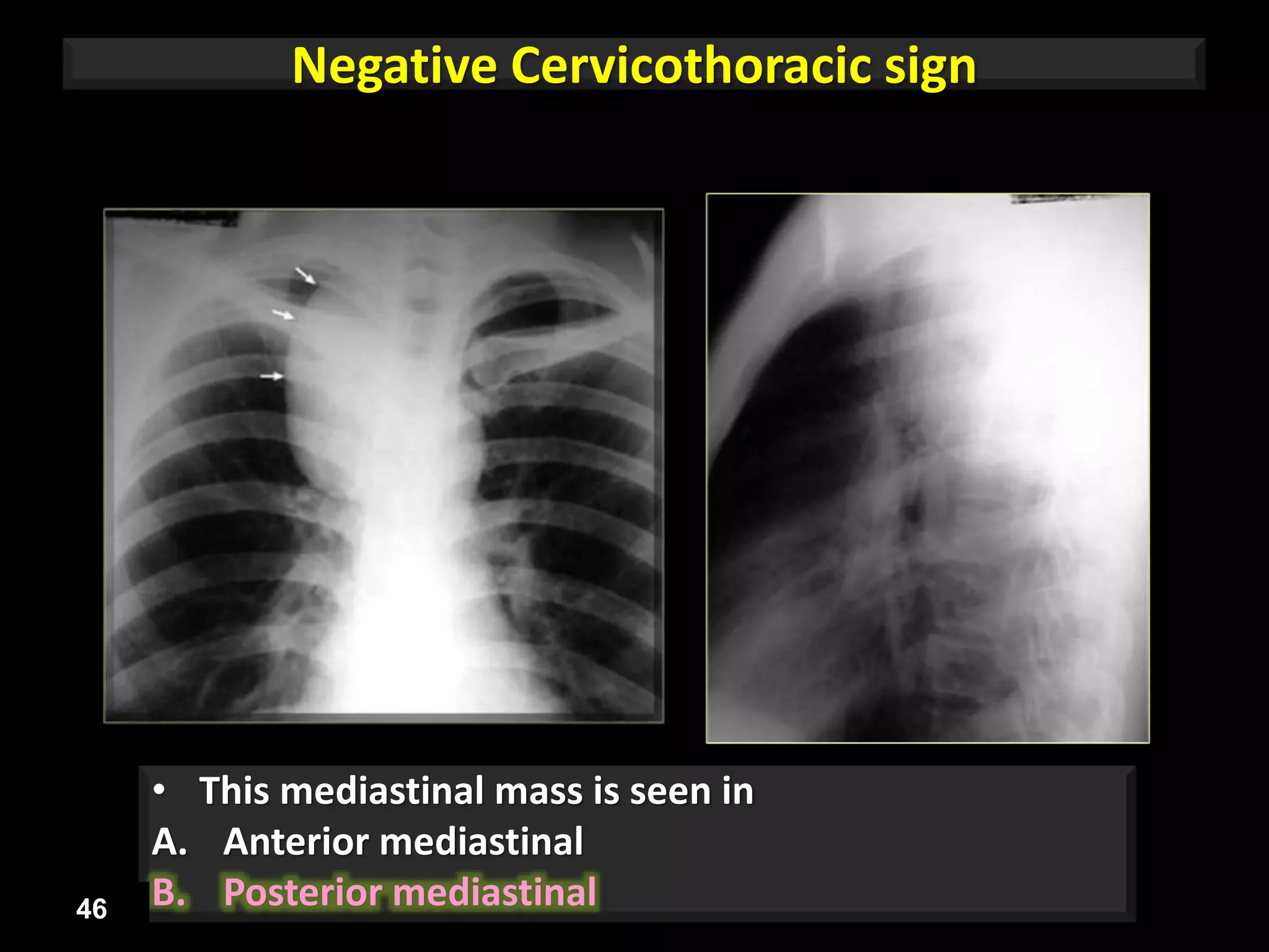 Gloved finger sign and cervicothoracic sign | PPTX
