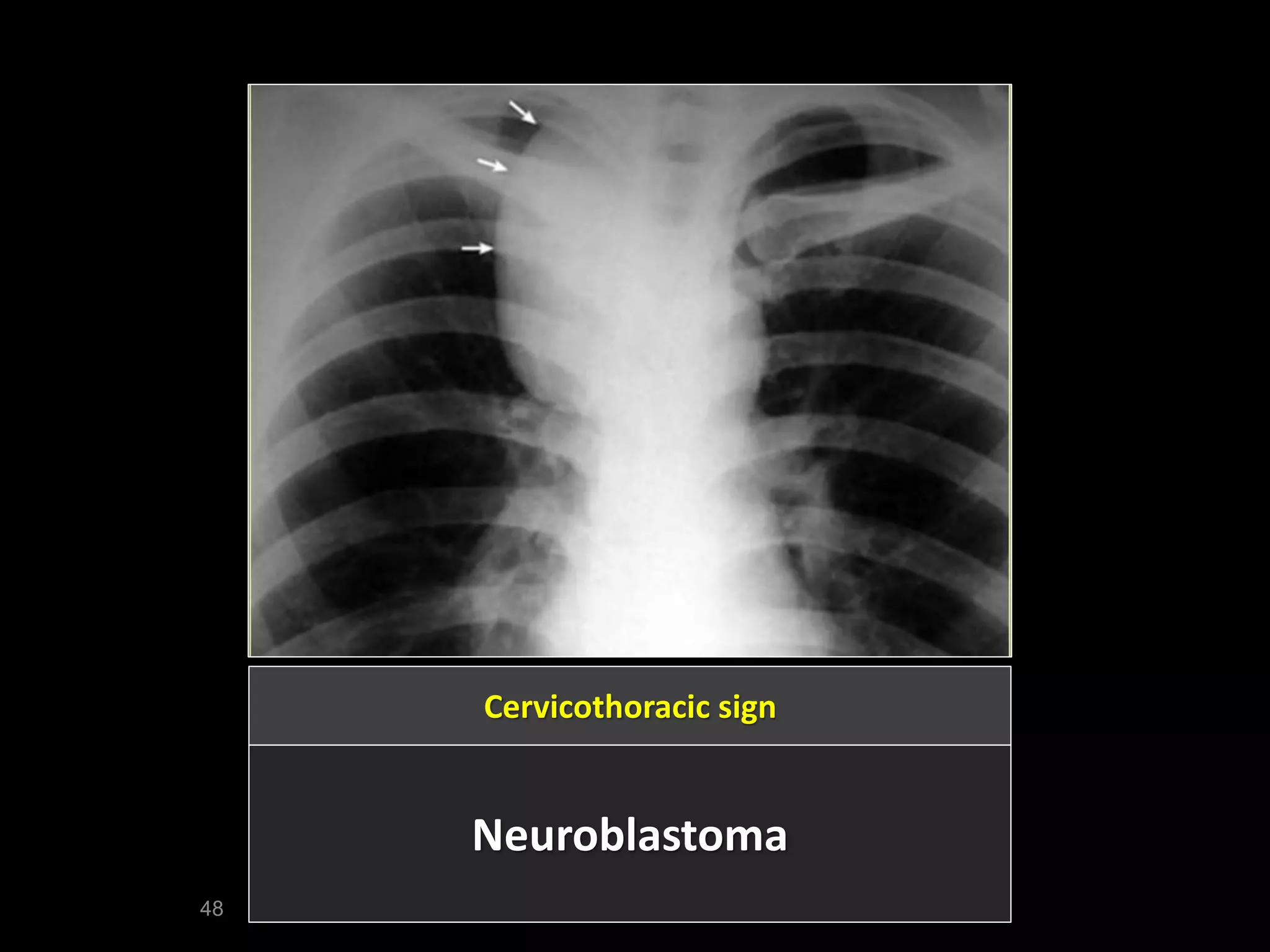 Gloved finger sign and cervicothoracic sign | PPTX