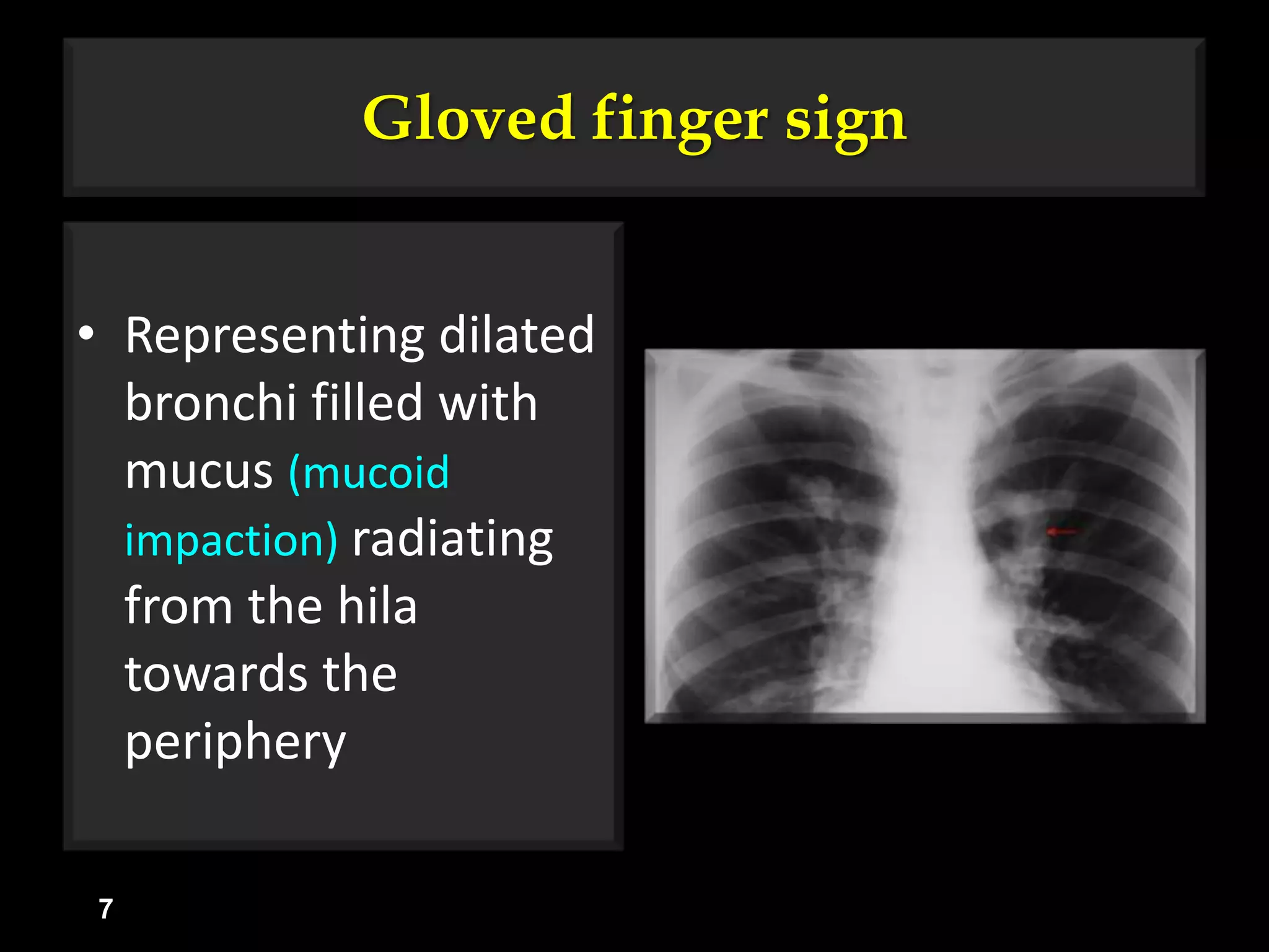 Gloved finger sign and cervicothoracic sign | PPTX