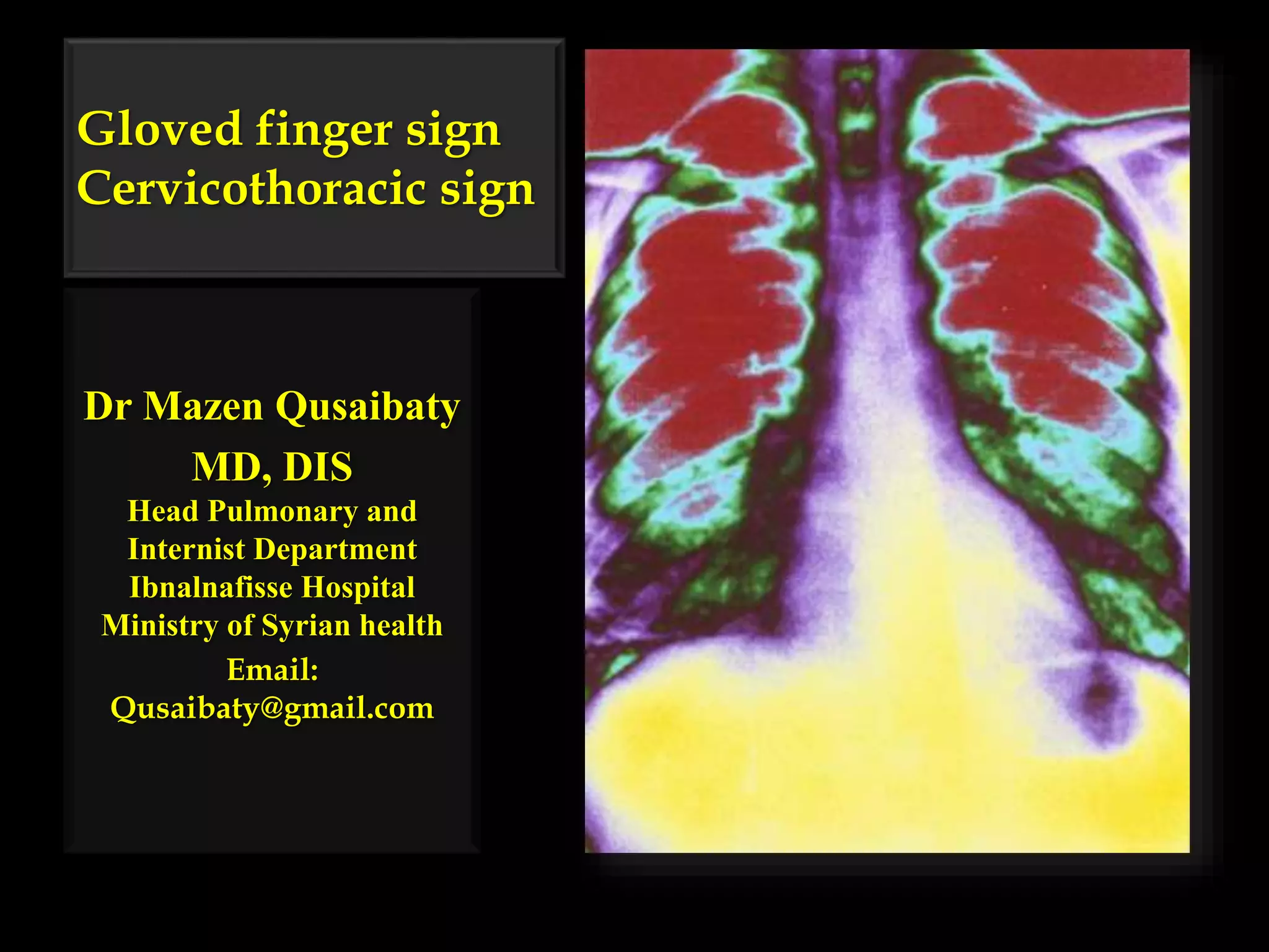 Gloved finger sign and cervicothoracic sign | PPT