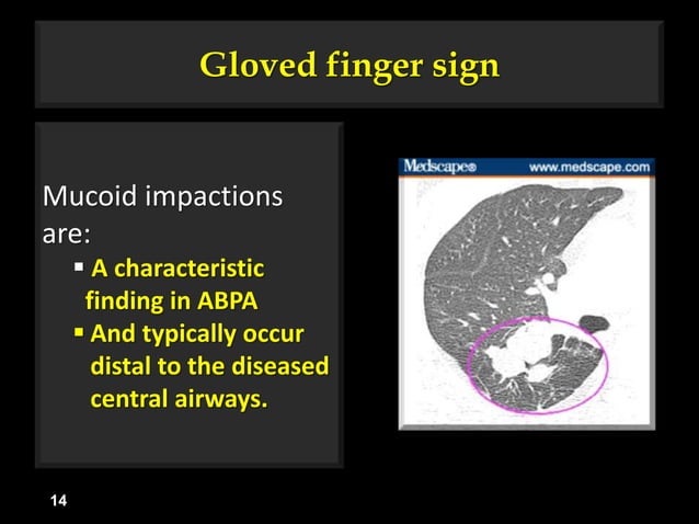 Gloved finger sign and cervicothoracic sign | PPTX