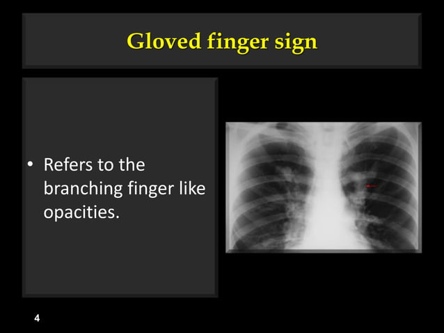 Gloved finger sign and cervicothoracic sign | PPTX