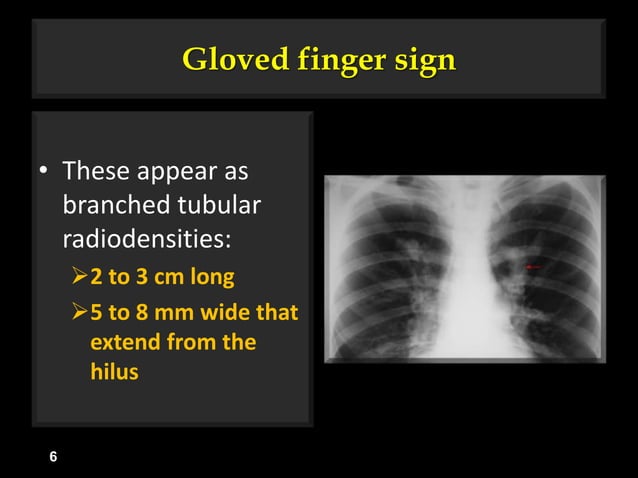 Gloved finger sign and cervicothoracic sign | PPTX