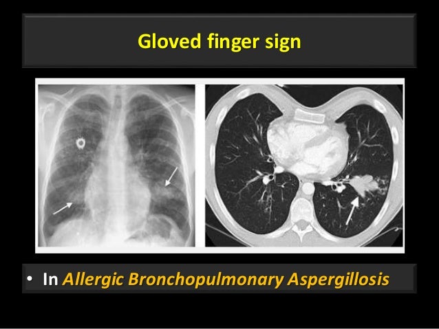 Gloved finger sign and cervicothoracic sign