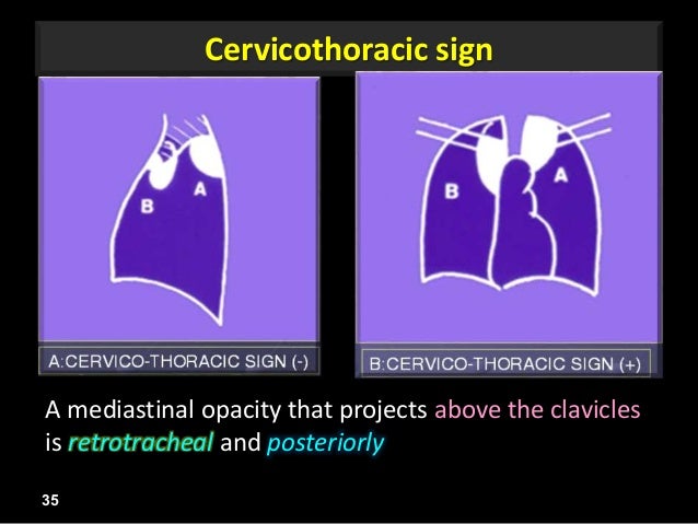 Gloved finger sign and cervicothoracic sign