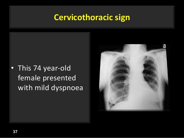 Gloved finger sign and cervicothoracic sign