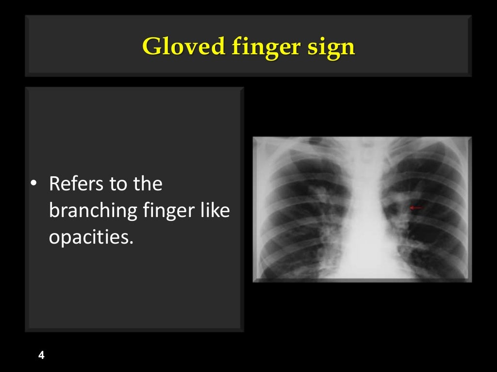 Gloved finger sign and cervicothoracic sign