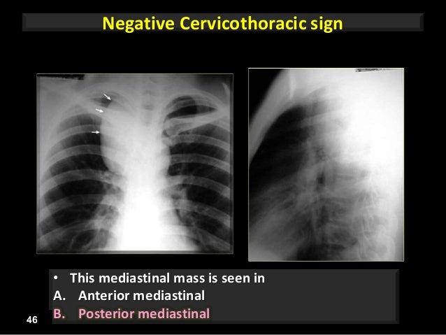 Gloved finger sign and cervicothoracic sign
