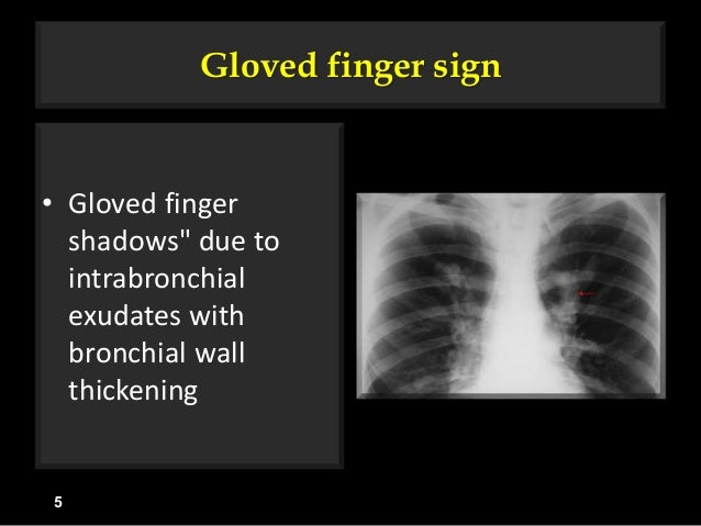 Gloved finger sign and cervicothoracic sign