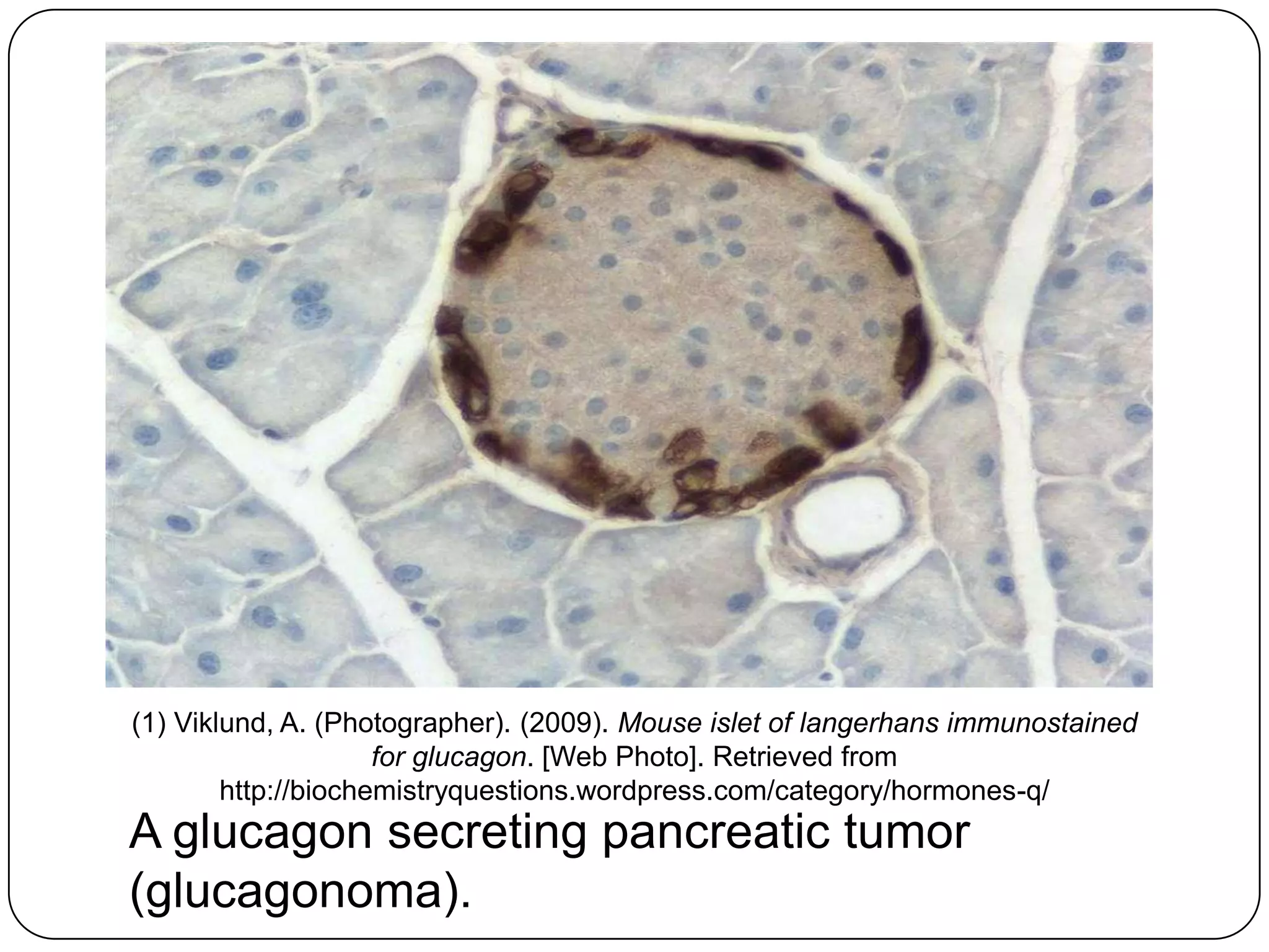 Glucagonoma | PPTX