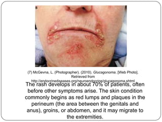 Glucagonoma | PPTX