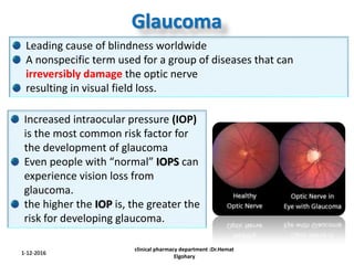 Glaucoma | PDF