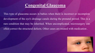 Glucoma.pptx