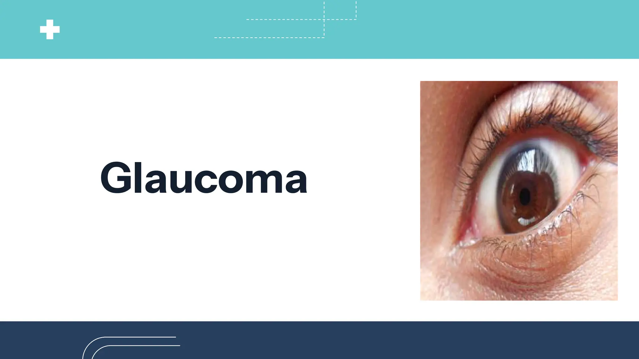 glucoma treatment mumbai | PPTX