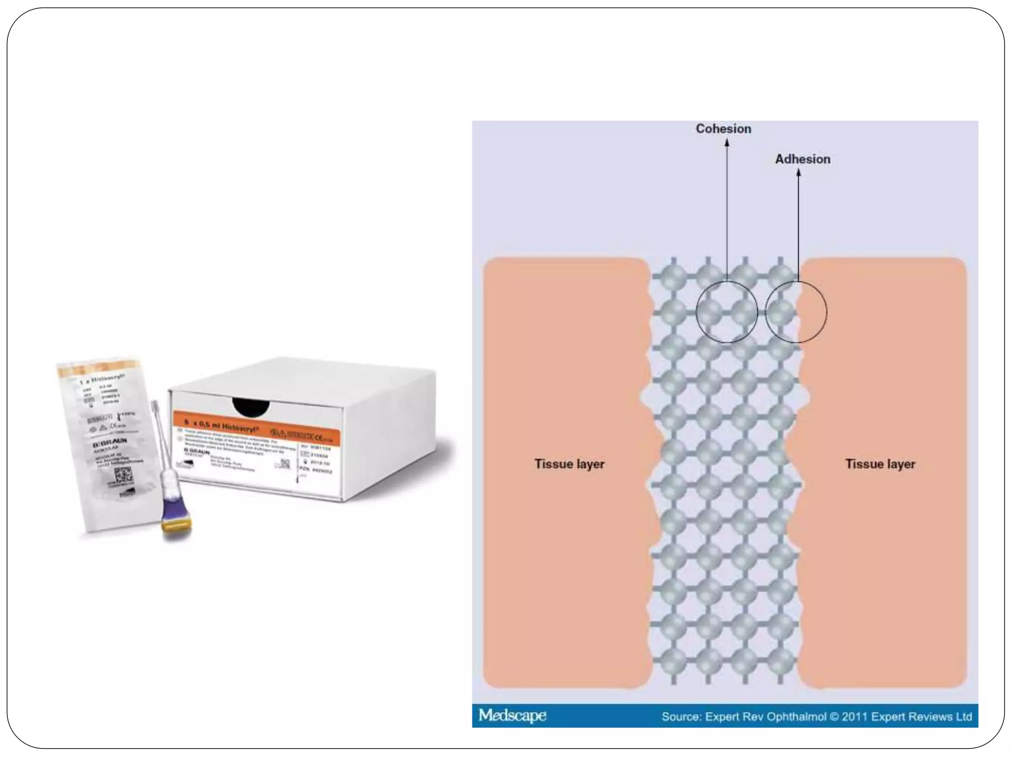 Tissue Adhesive In Ophthalmology | PPTX