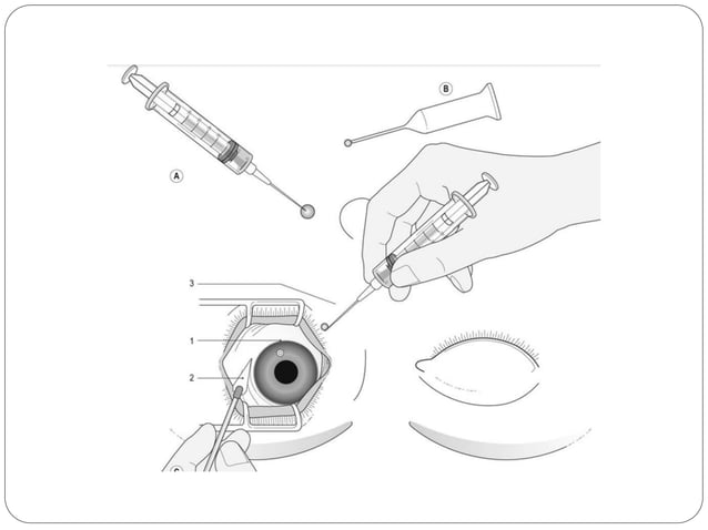 Tissue Adhesive In Ophthalmology | PPTX | Eye and Vision Conditions ...