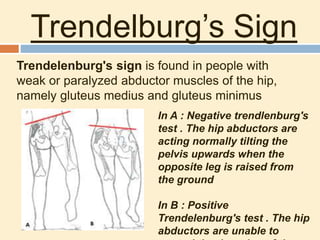 Trendelenburg Sign