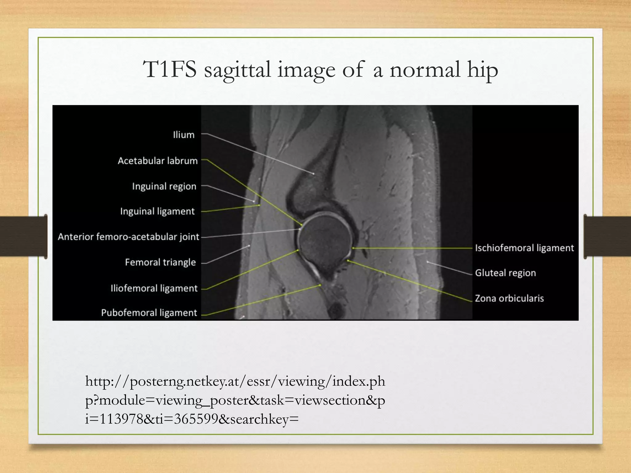 Gluteal region clinical anatomy | PDF