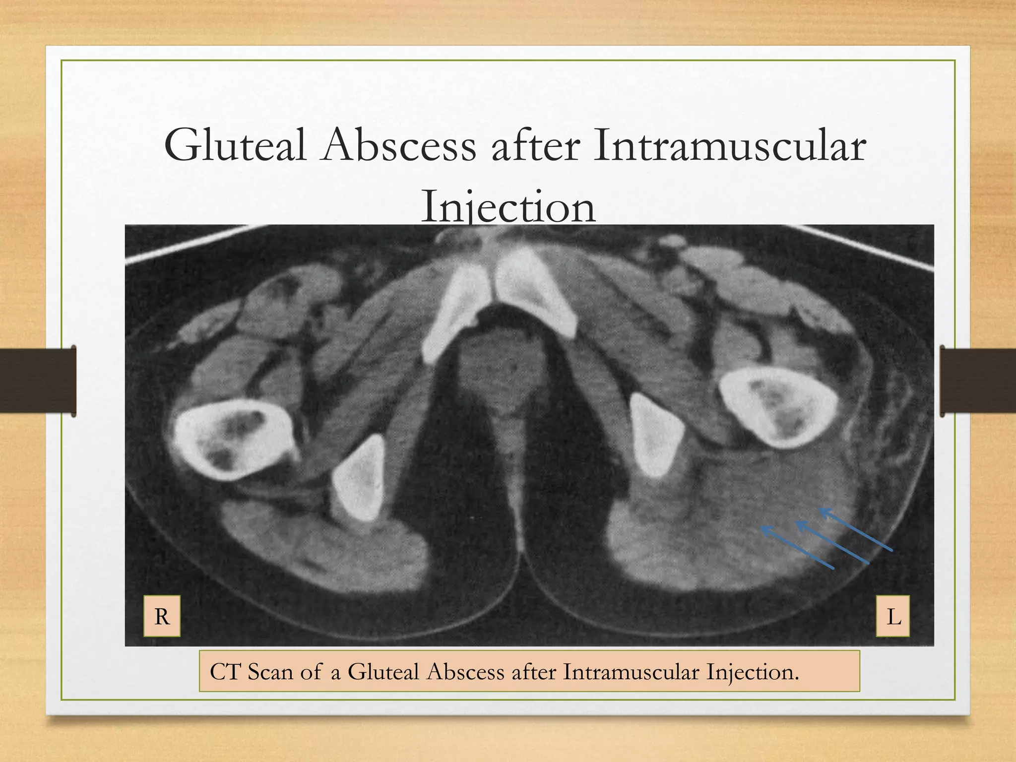 Gluteal region clinical anatomy | PDF