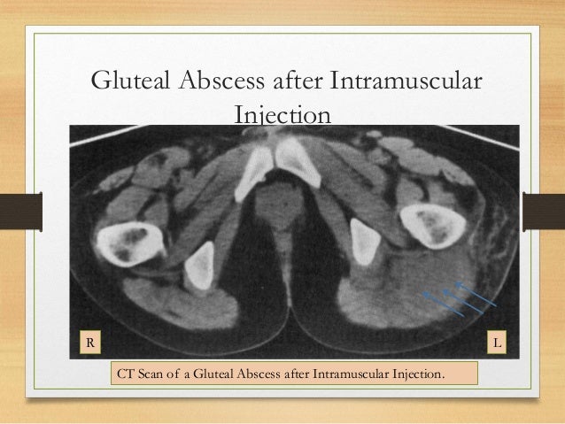 Gluteal region clinical anatomy