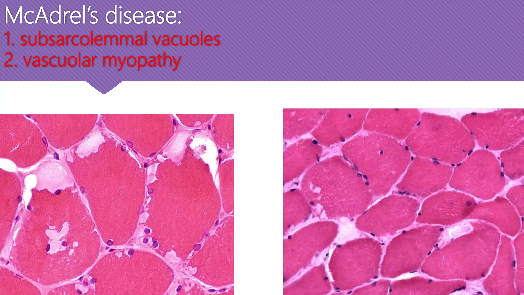 Glycogen storage disorders pathology | PPTX