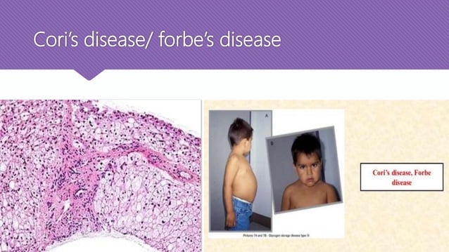 Glycogen storage disorders pathology | PPTX | Diabetes | Diseases and ...