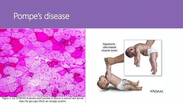 Glycogen storage disorders pathology
