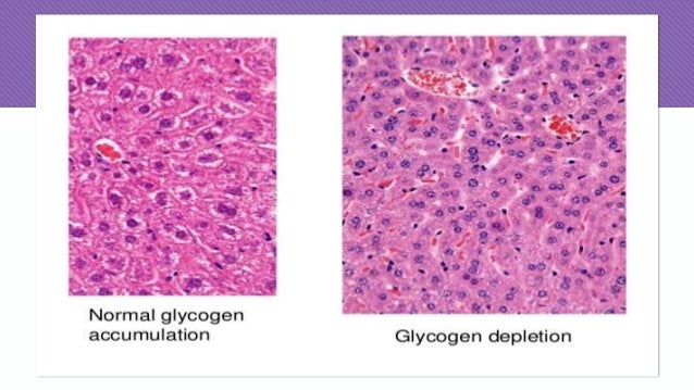 Glycogen storage disorders pathology