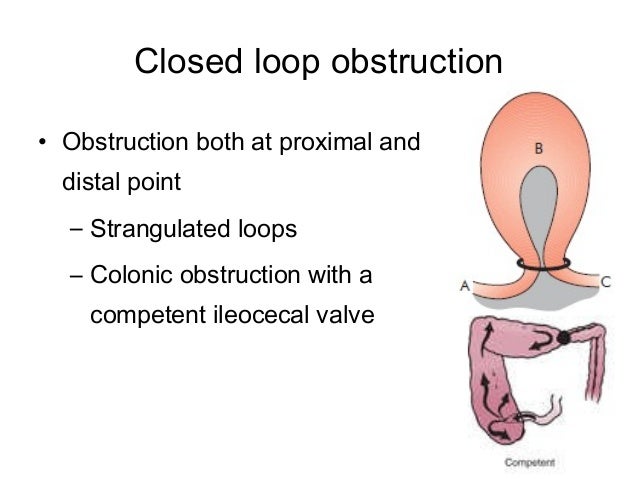 Intestinal obstruction neo