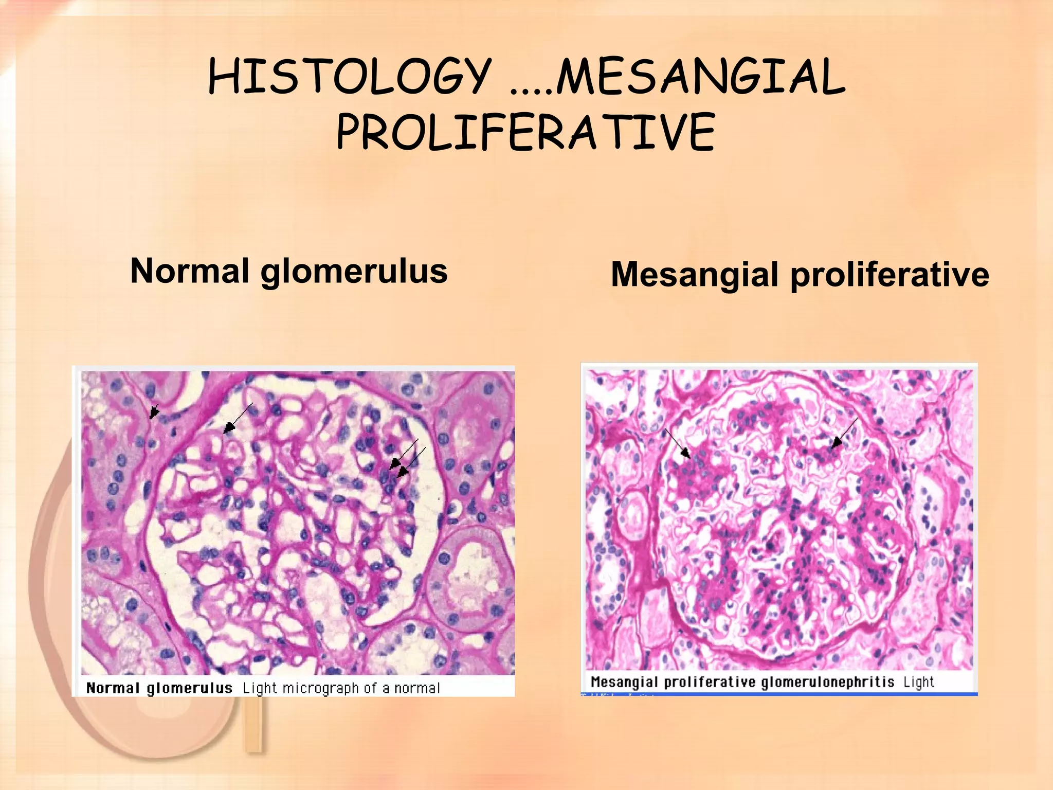 Pathogenesis of Glomerulonephritis | PPT