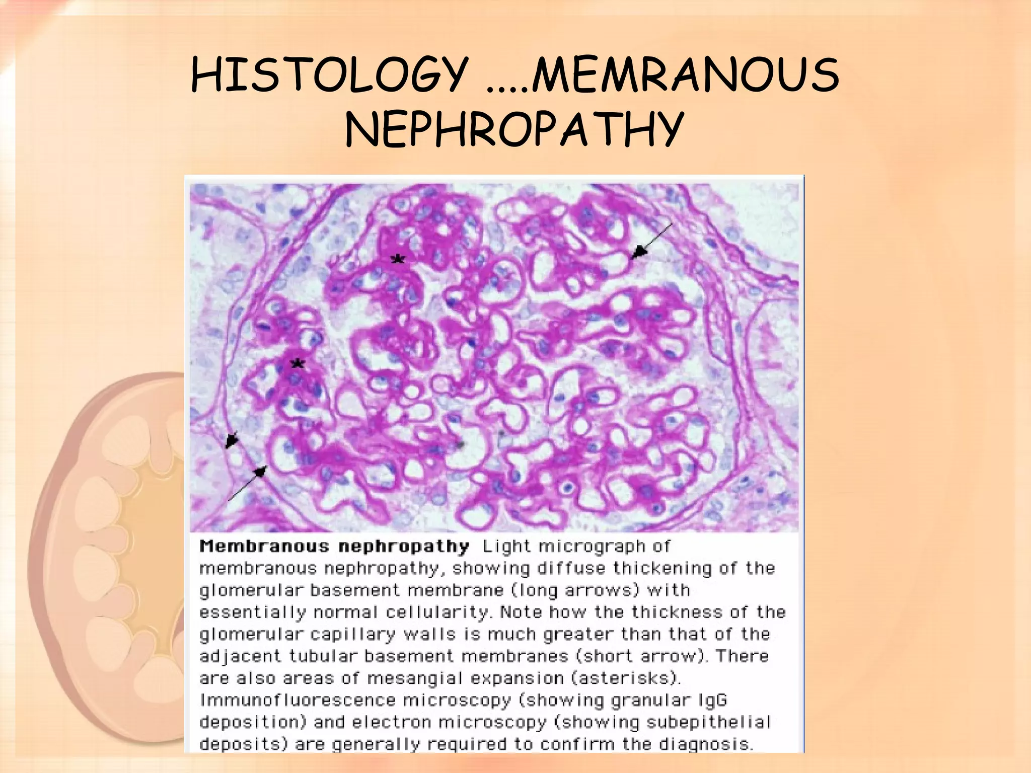 Pathogenesis of Glomerulonephritis | PPT