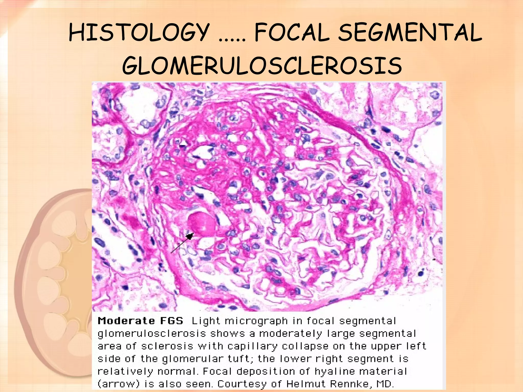 Pathogenesis of Glomerulonephritis | PPT