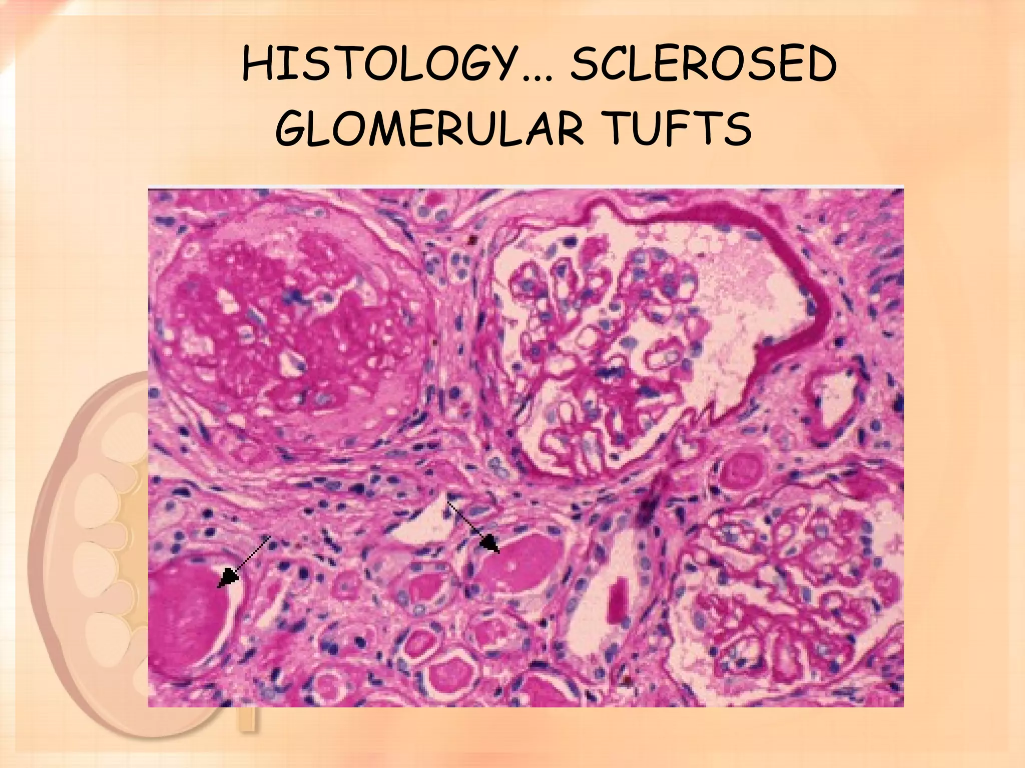 Pathogenesis of Glomerulonephritis | PPT