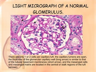 Pathogenesis of Glomerulonephritis | PPT
