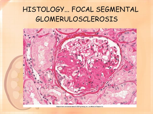 Pathogenesis of Glomerulonephritis | PPT | Diseases and Conditions | Medical Health