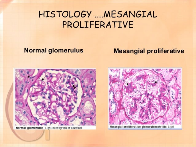 Pathogenesis of Glomerulonephritis