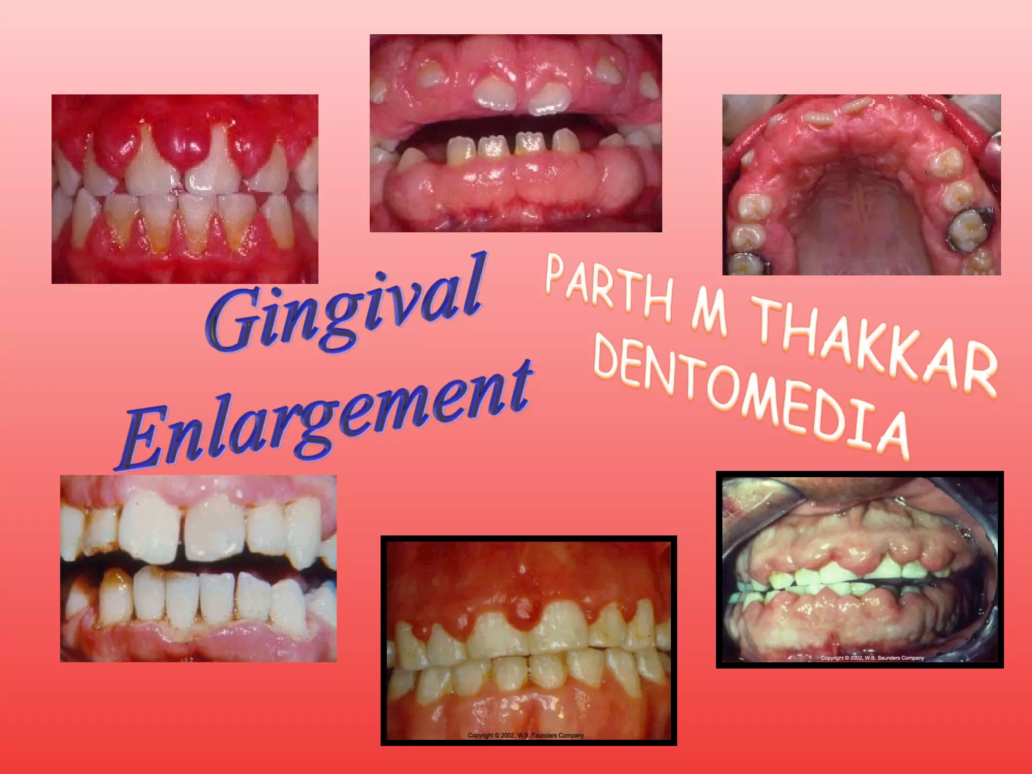 Gingival Enlargement Causes, Types & Grading | PPT